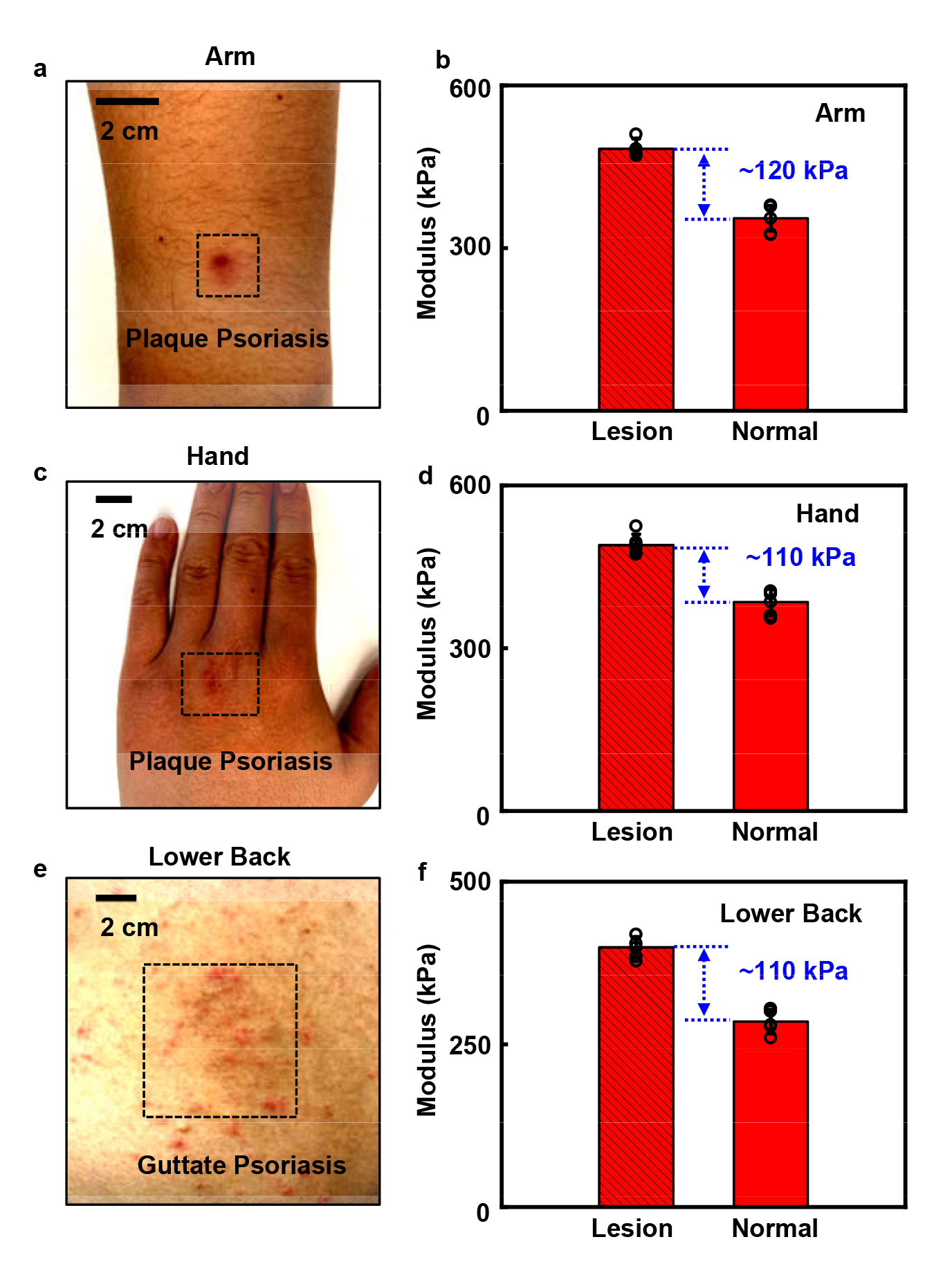 Detecting skin disorders based on tissue stiffness with a soft sensing ...